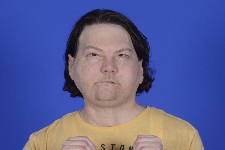 Vítima de acidente de carro recebe primeiro transplante de face e mãos ...