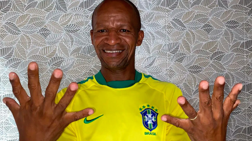 Baiano com seis dedos em cada mão quer usar uma só para comemorar o ...
