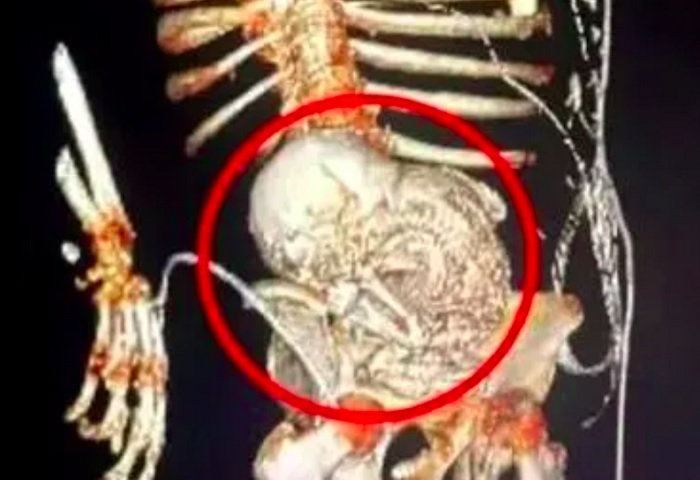 Mulher passa cinco décadas com feto calcificado na barriga